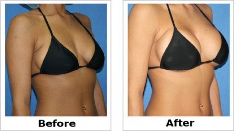 Top 5 Reasons To Get Gummy Bear Implants Blog Medicine 4612